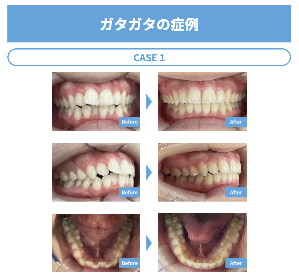 【満足いく？】スマイルモア矯正利用者のリアルな口コミ！やばいって本当？ | HANARABIST
