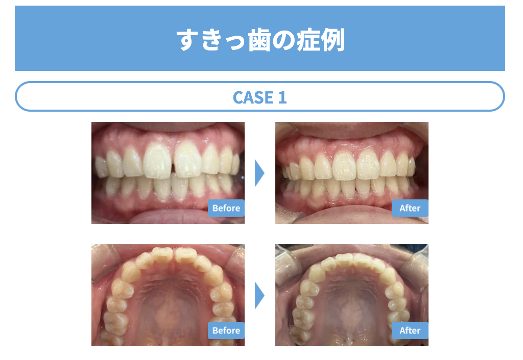 【満足いく？】スマイルモア矯正利用者のリアルな口コミ！やばいって本当？ | HANARABIST